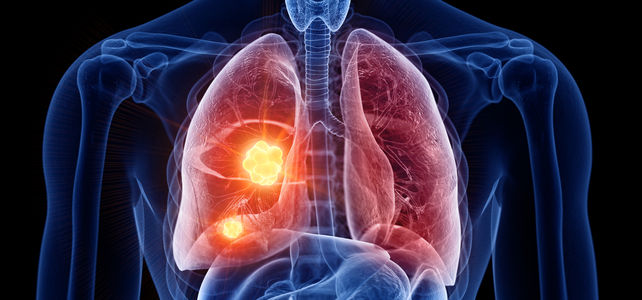 NSCLC: Osimertinib as first-line therapy improves overall survival